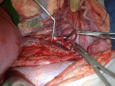 internal bleeding abdominal surgery