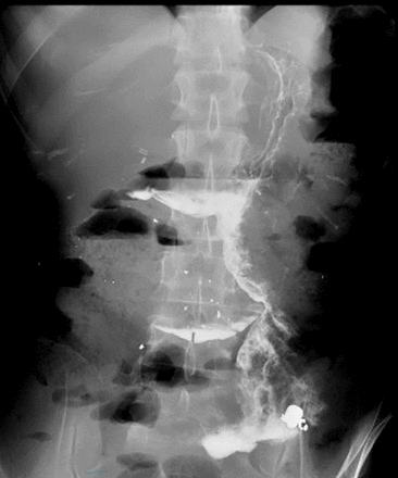 Repairing a remote complication of abdominal penetrating trauma ...