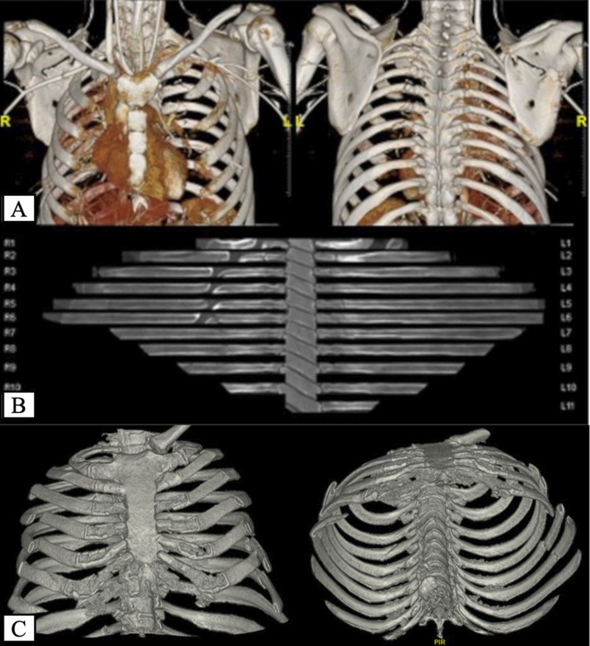 Surgical stabilization of rib fractures in conjunction with veno-venous ...