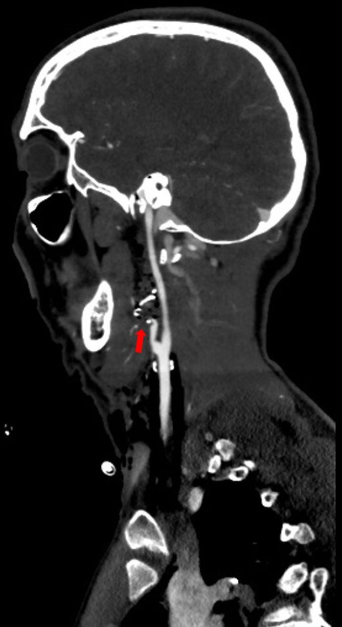 Management of penetrating neck injury to zone III in an initially ...