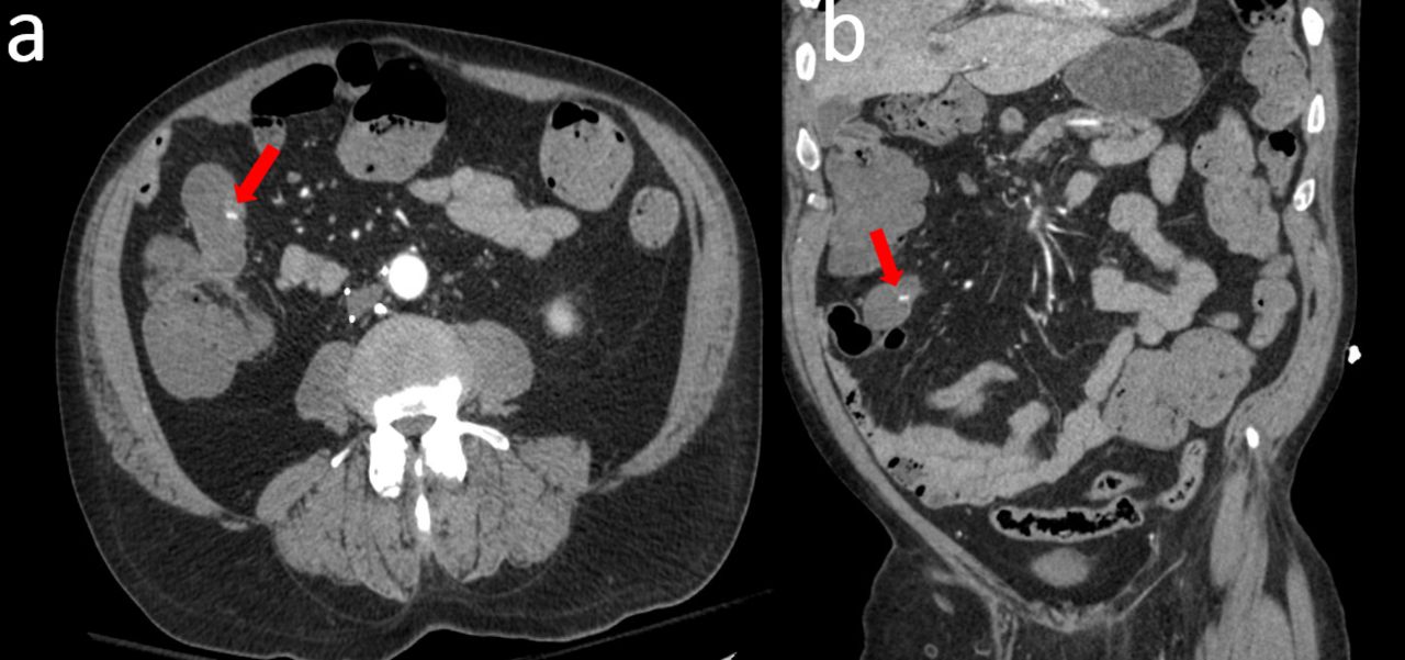 Massive lower gastrointestinal bleeding due to Meckel’s diverticulum in ...