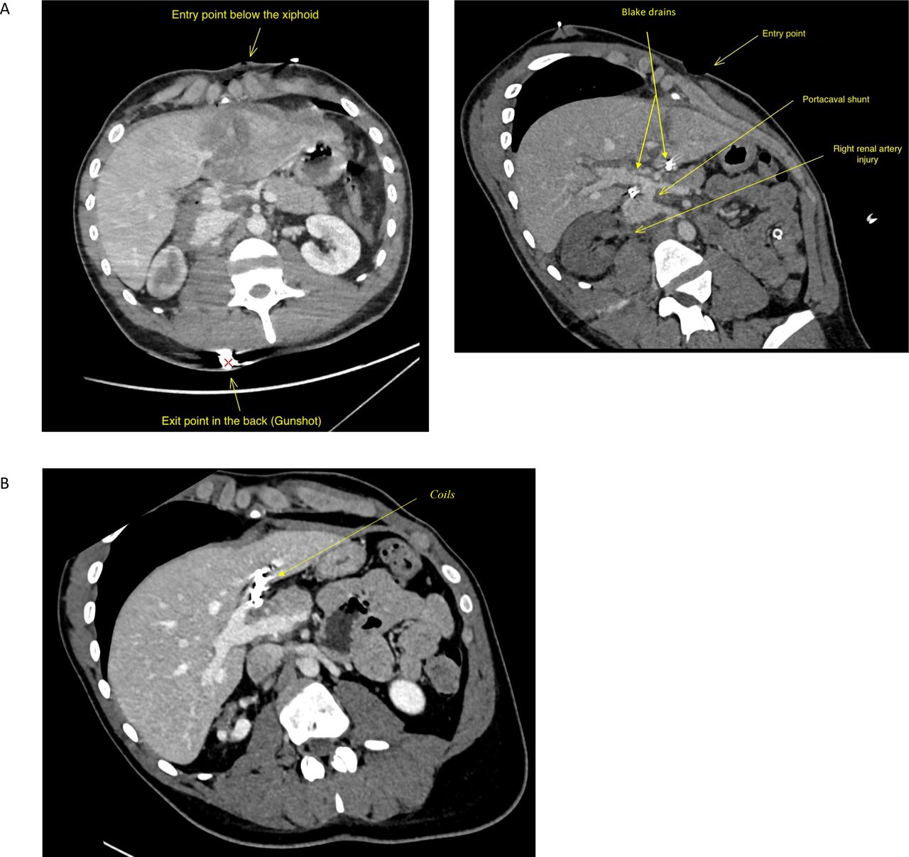 Traumatic portacaval shunt: a rare complication to be considered in ...