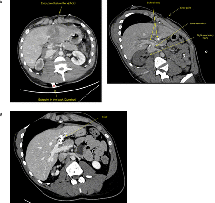 Traumatic portacaval shunt: a rare complication to be considered in ...