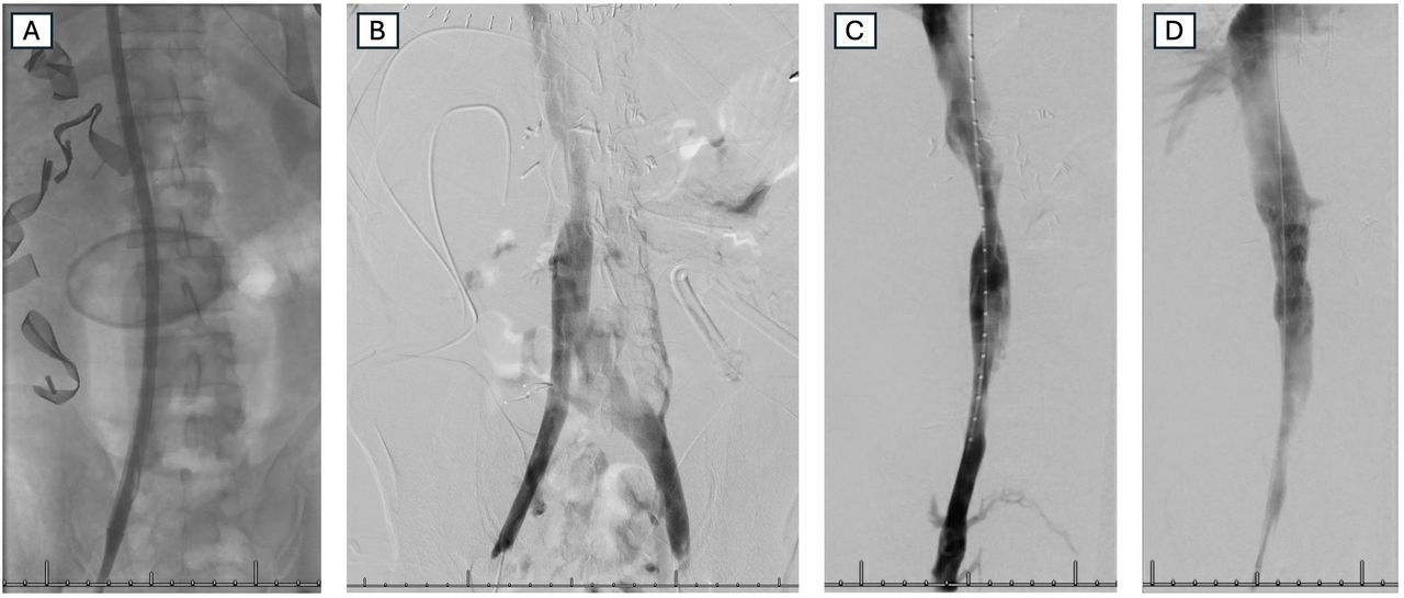 Prolonged atriocaval shunt utilization as a damage control tool for the ...