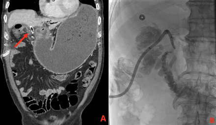 Drain erosion into duodenum after cholecystectomy | Trauma Surgery ...