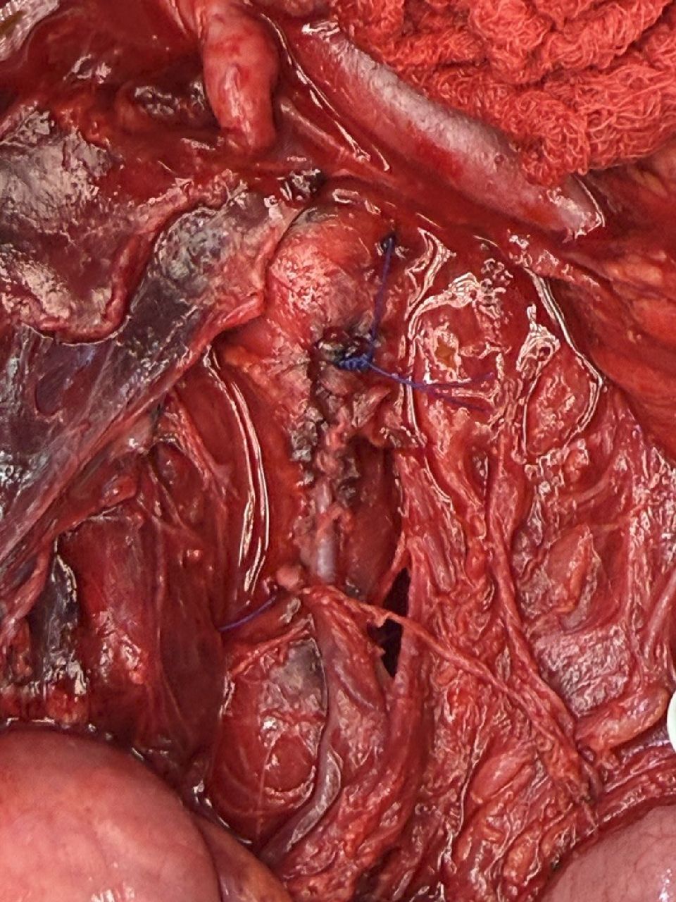 Management of combined blunt inferior vena cava and extrahepatic common ...