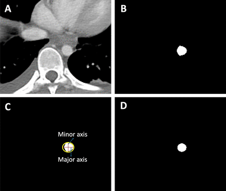 Age-stratified analysis of descending aorta diameter in traumatic ...