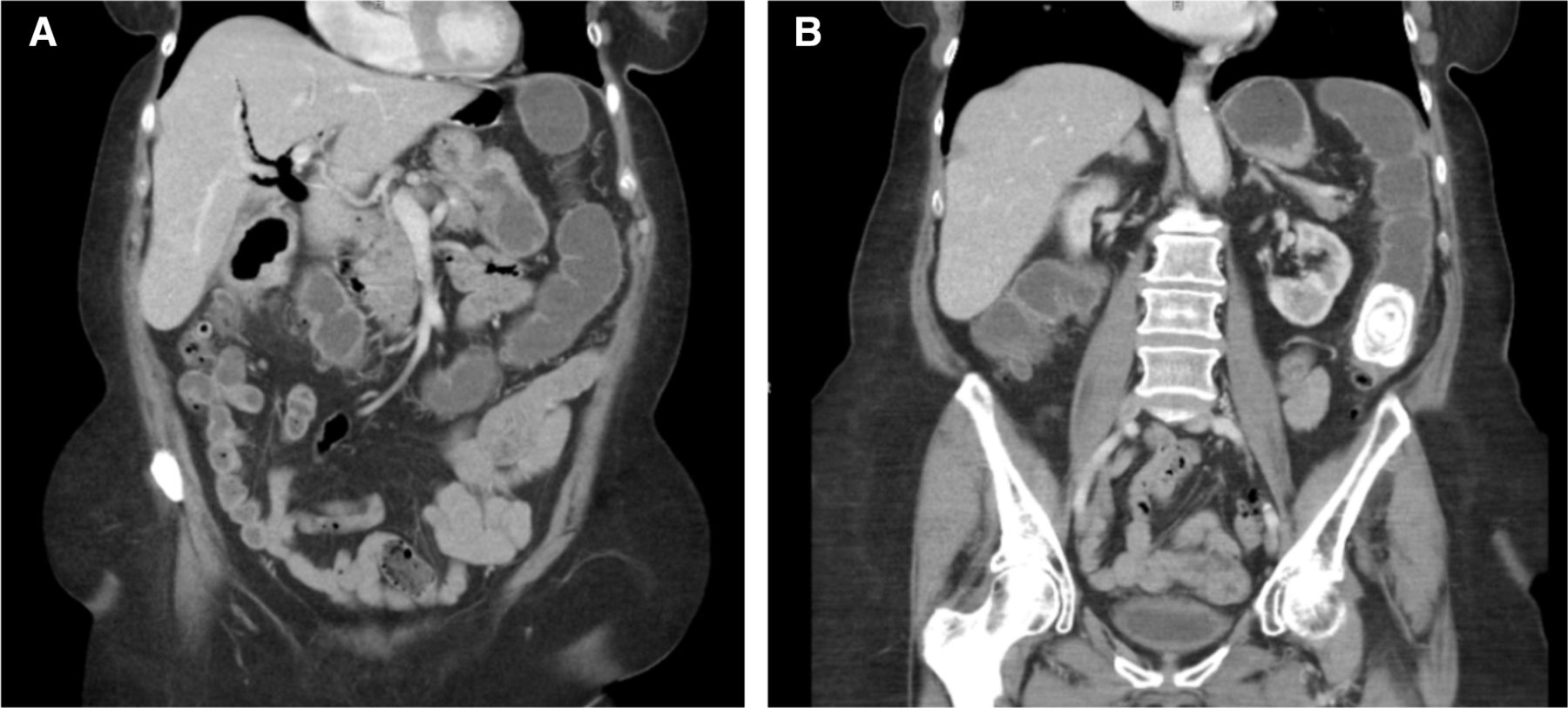 Cholecystocolonic fistula: an unusual presentation of large bowel ...