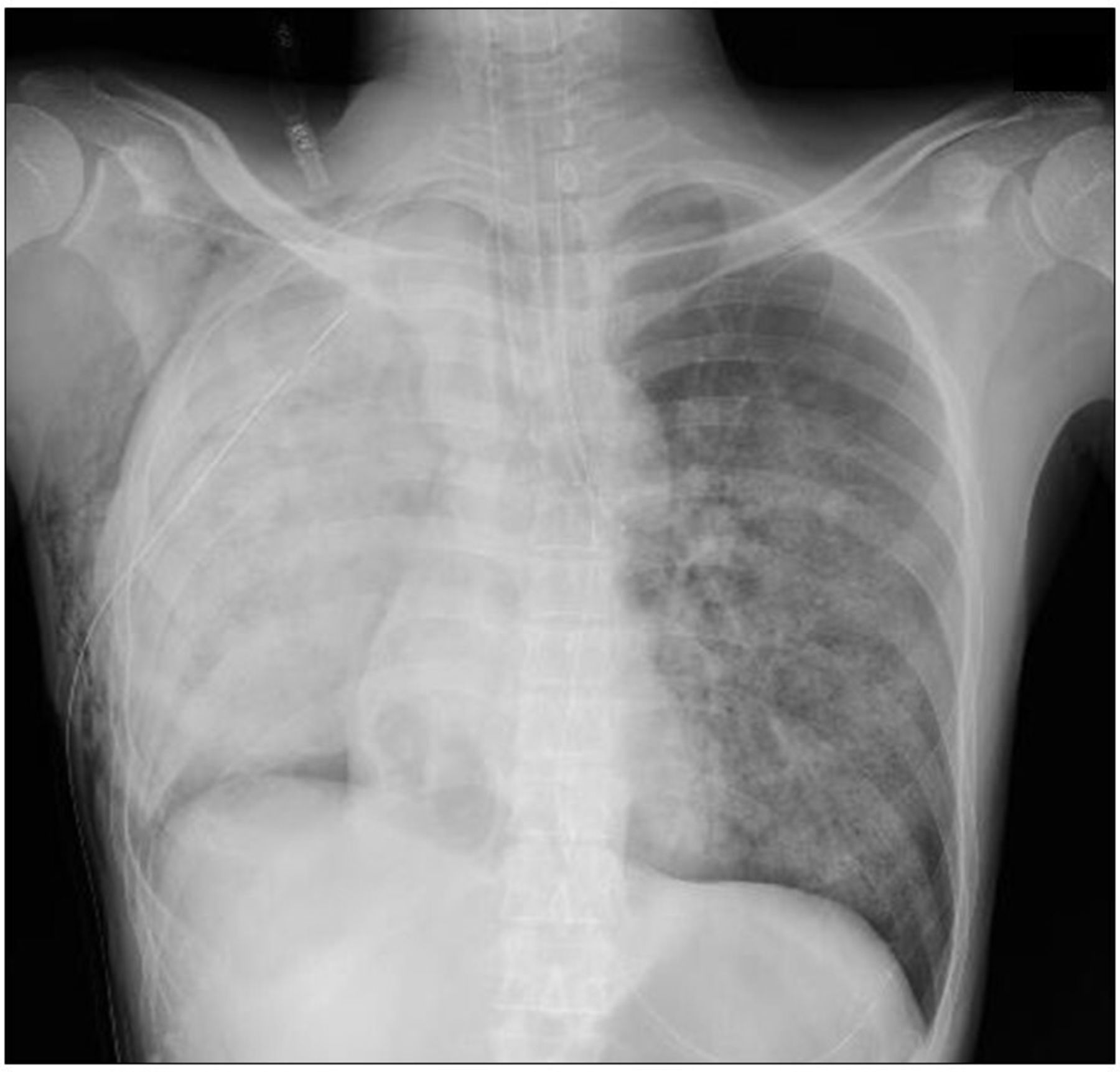 Massive hemoptysis secondary to hemorrhagic traumatic pulmonary ...