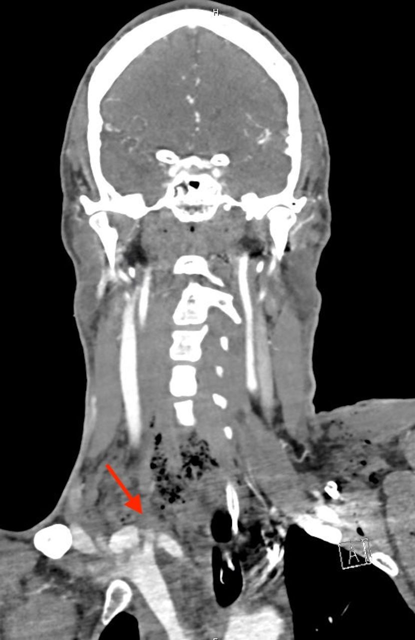 Traumatic subclavian artery injury with a pulmonary artery bullet ...