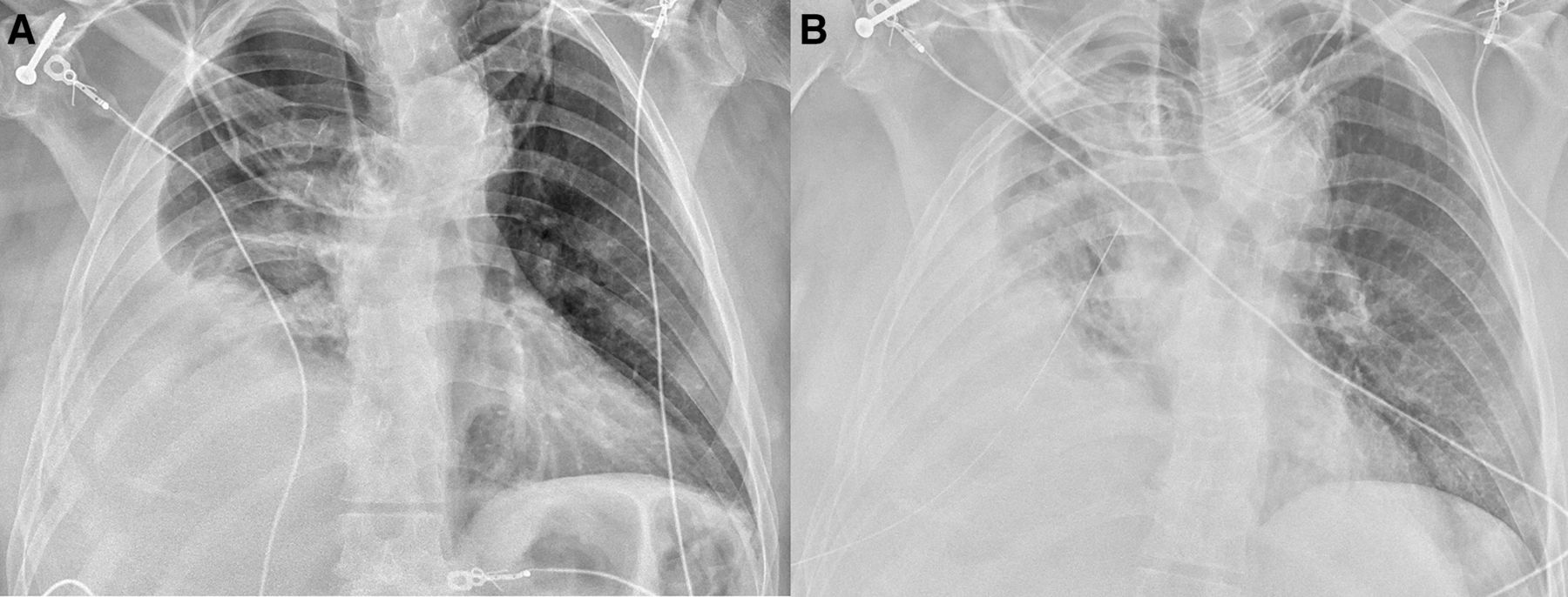 Immediate chest wall stabilization following thoracotomy for hemorrhage ...