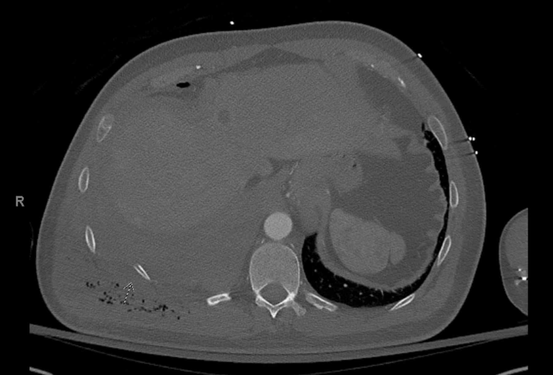 Immediate chest wall stabilization following thoracotomy for hemorrhage ...