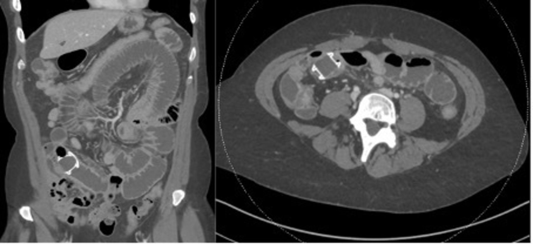 Small bowel obstruction due to a migrated pyloric stent | Trauma ...