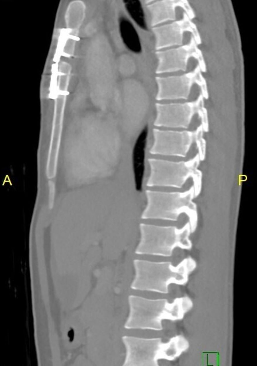 Stabilization of the anterior flail chest and lung resection in a ...