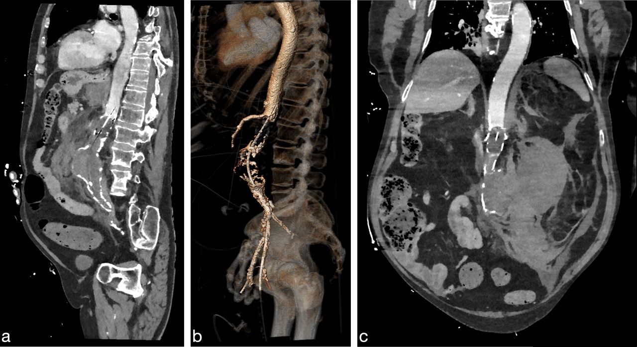 Resuscitative endovascular balloon occlusion of the aorta (REBOA) for ...